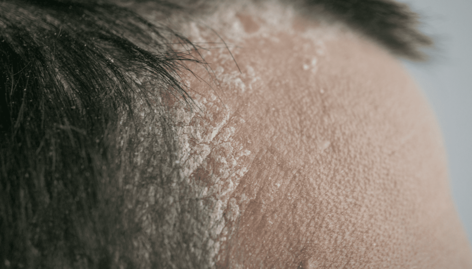 Como identificar doenças do couro cabeludo: Dicas essenciais